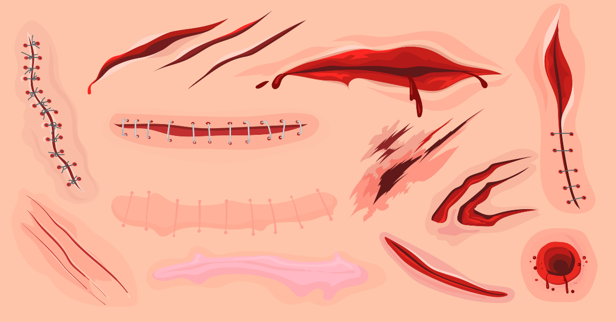 Suture 101: Everything You Need to Know About Different Types of Sutur – Suture Kit