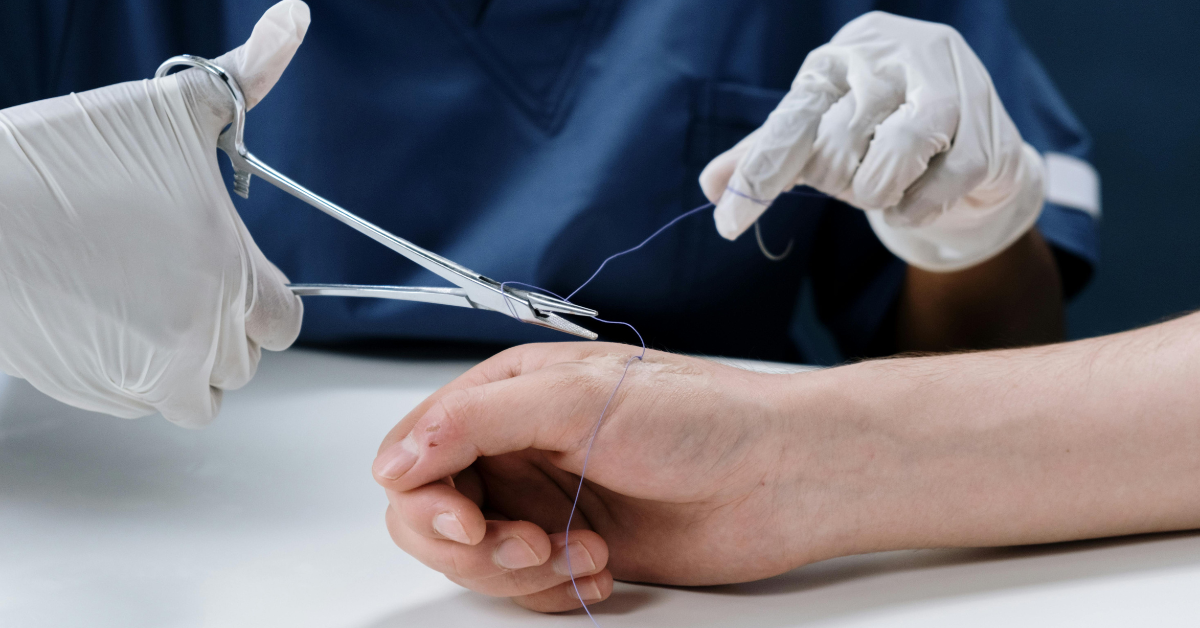 How to Remove Stitches at Home Safely and Effectively – Suture Kit